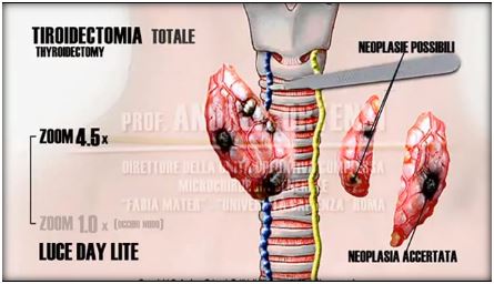 Anatomia Da Tireoidectomia
